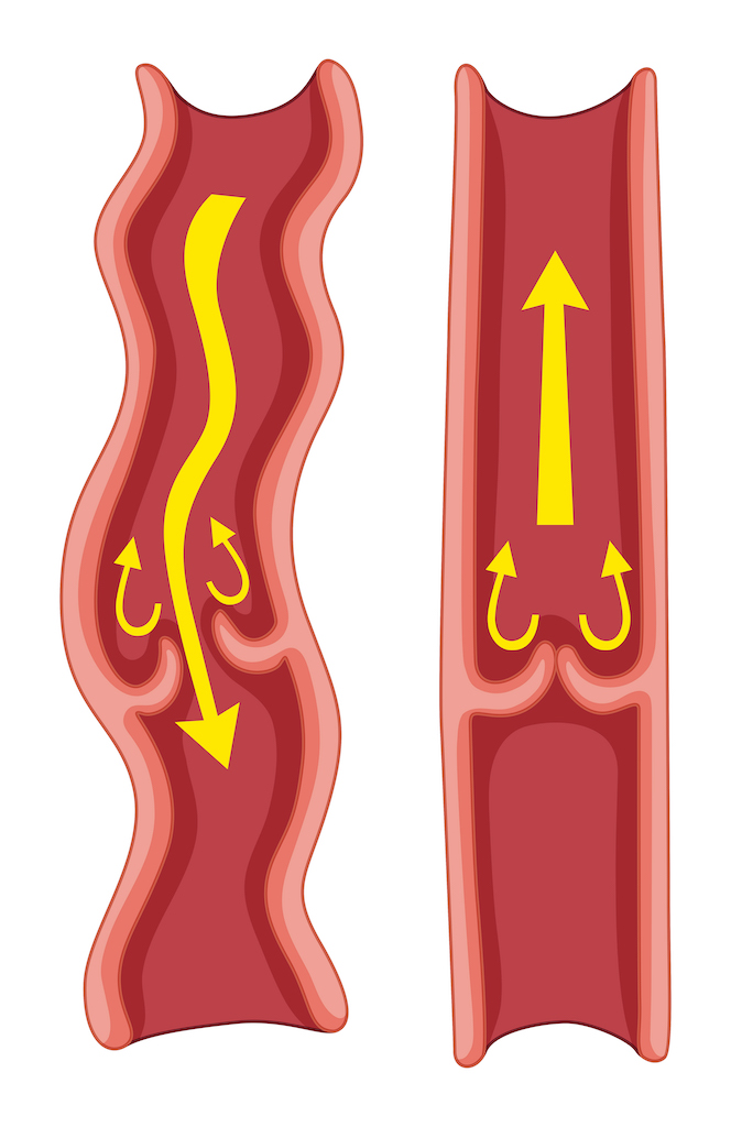 Comment traiter efficacement les varices de la jambe