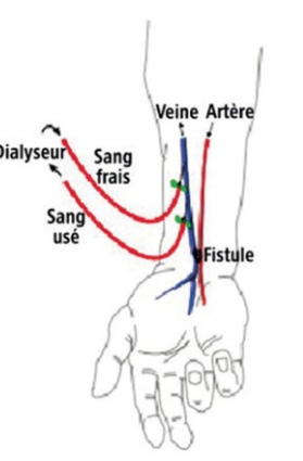 Fistules artério veineuse - Chirurgie Vasculaire Marseille